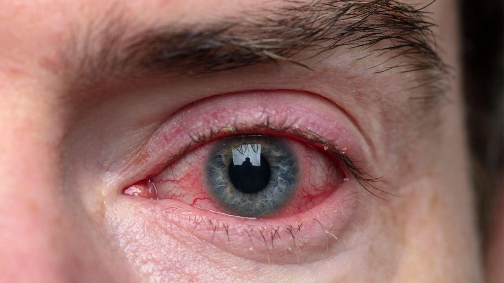ITeraCare For Eye Problems